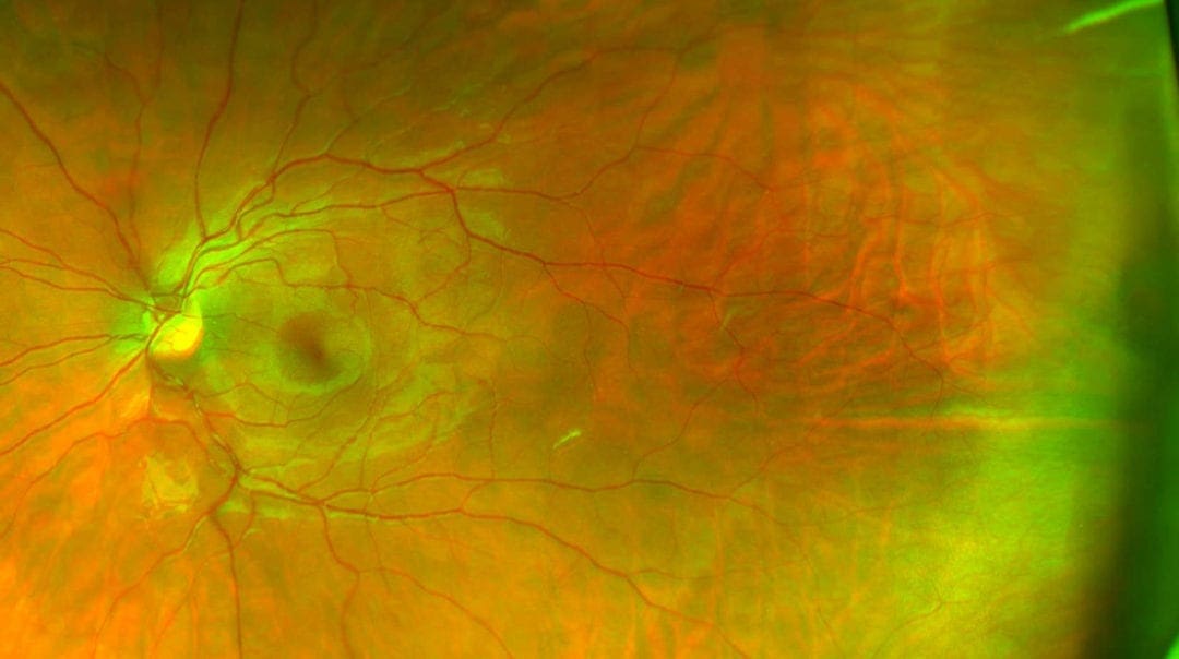 The Importance Of Routine Dilated Eye Examinations | Wyomissing ...